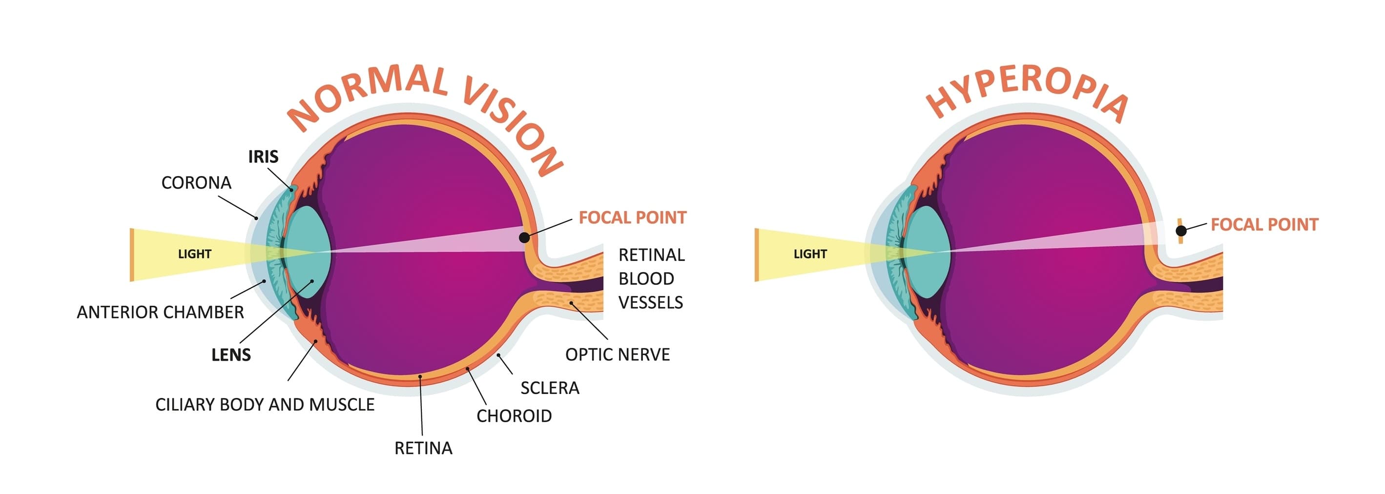 Lasik for farsightedness store